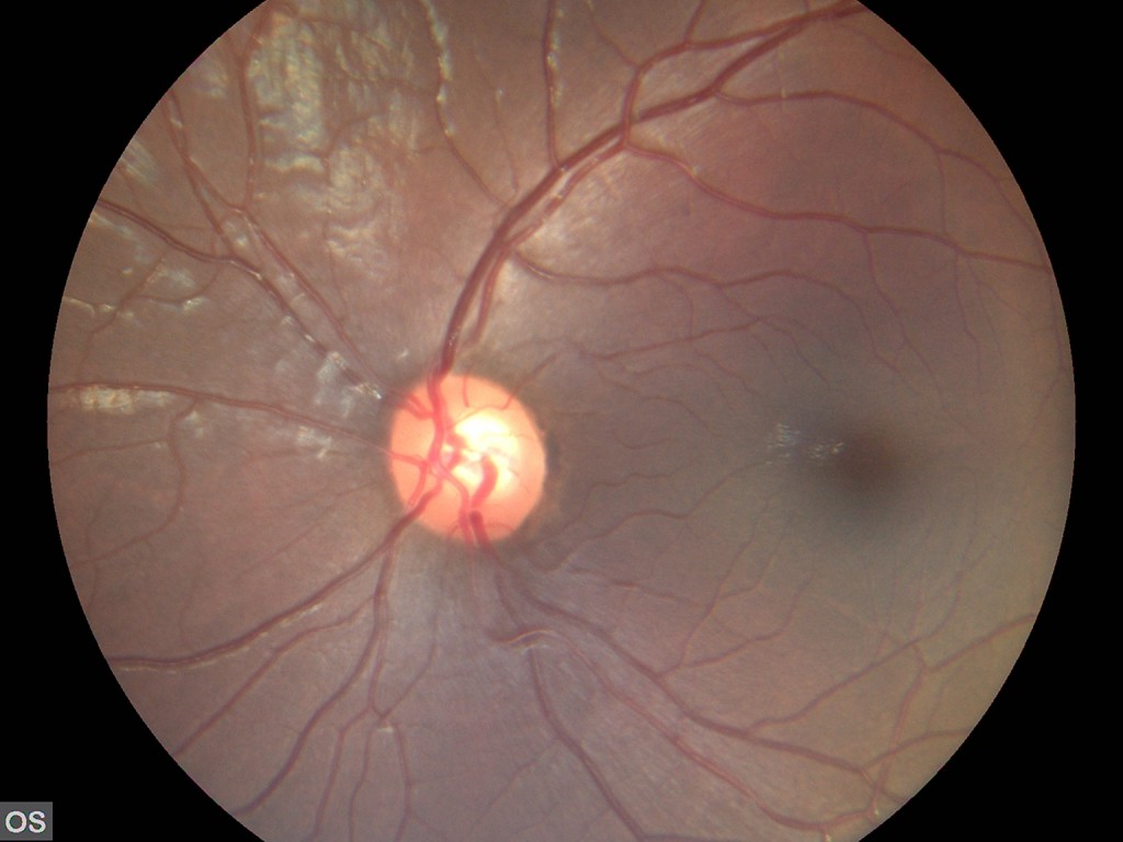 OPTOMED – Fundus Camera Portatile SMARTSCOPE PRO – Opto Medica