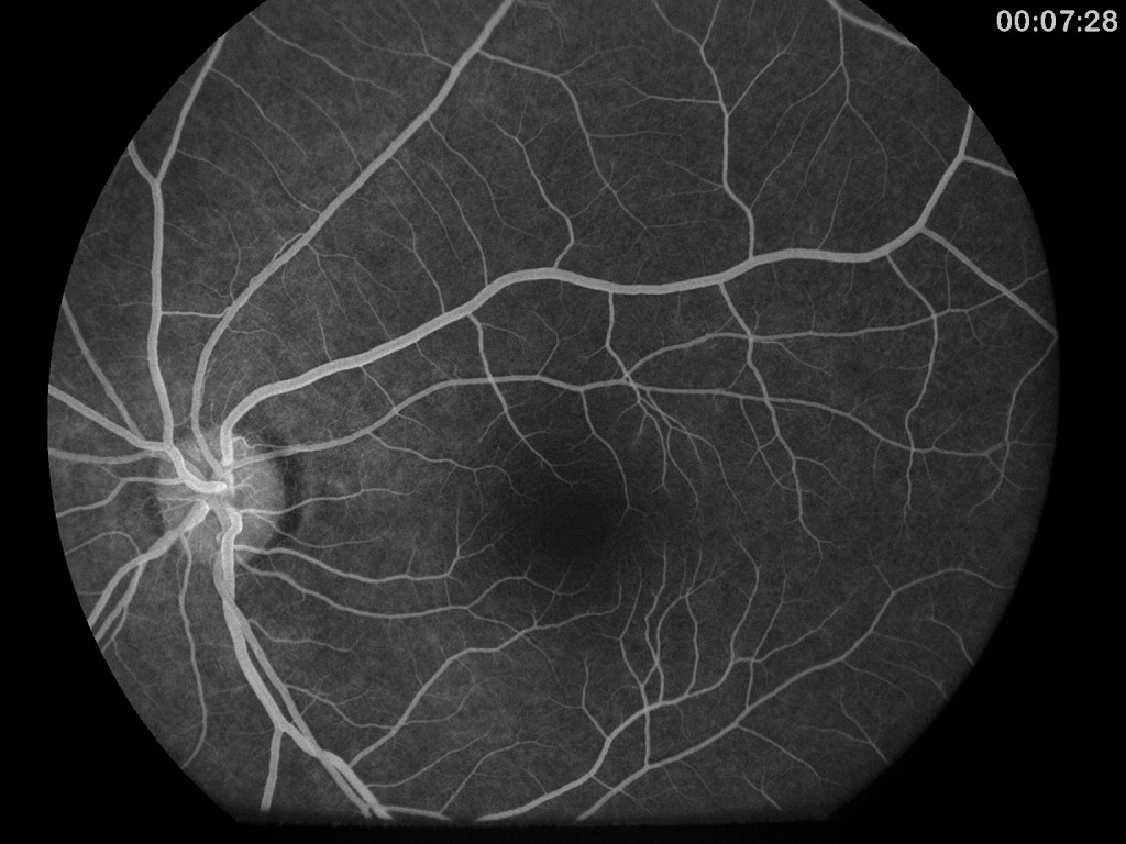 OPTOMED – Fundus Camera Portatile SMARTSCOPE PRO – Opto Medica