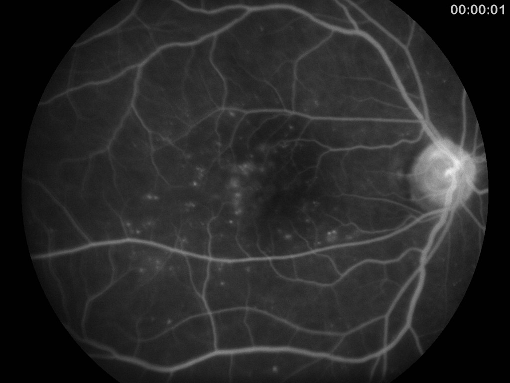 OPTOMED – Fundus Camera Portatile SMARTSCOPE PRO – Opto Medica