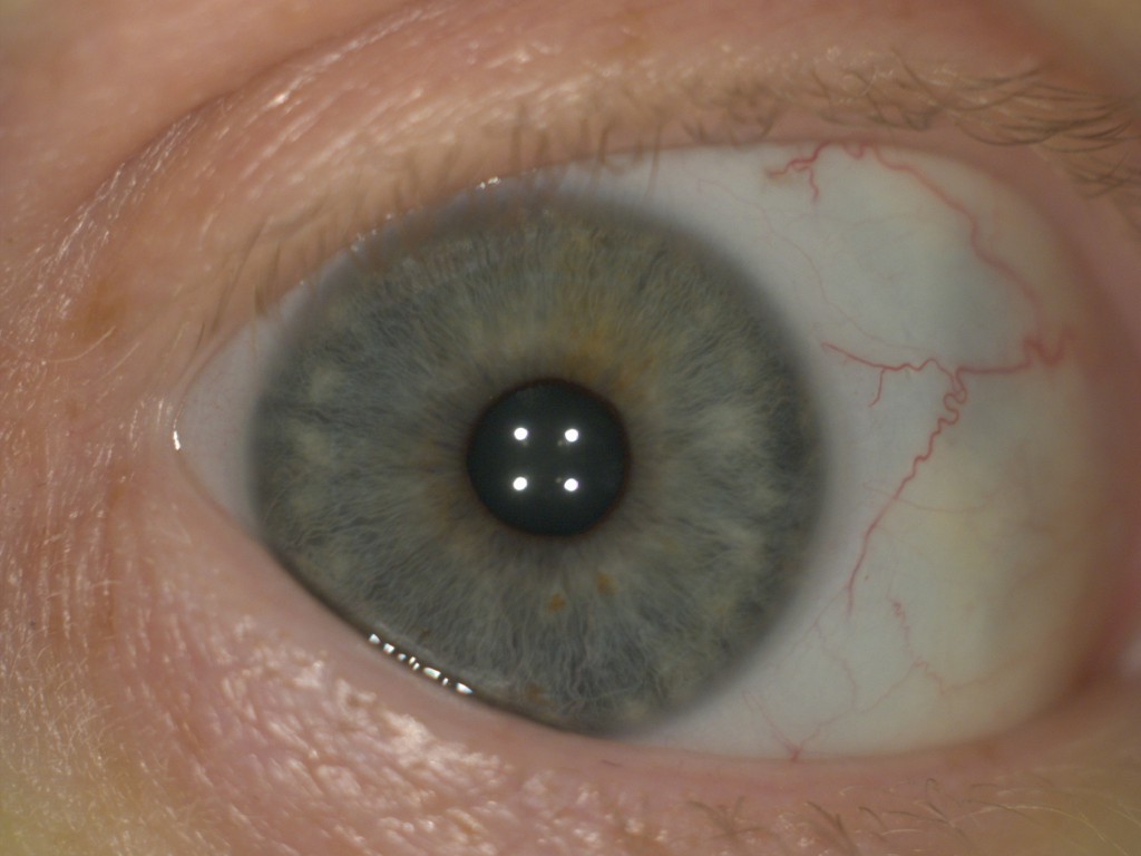 OPTOMED – Fundus Camera Portatile SMARTSCOPE PRO – Opto Medica