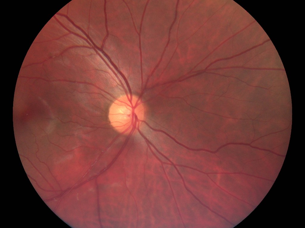 OPTOMED – Fundus Camera Portatile SMARTSCOPE PRO – Opto Medica