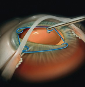 MST – Malyugin Ring – Opto Medica