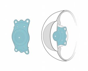 Lente Intraoculare fachica IpCL – Opto Medica